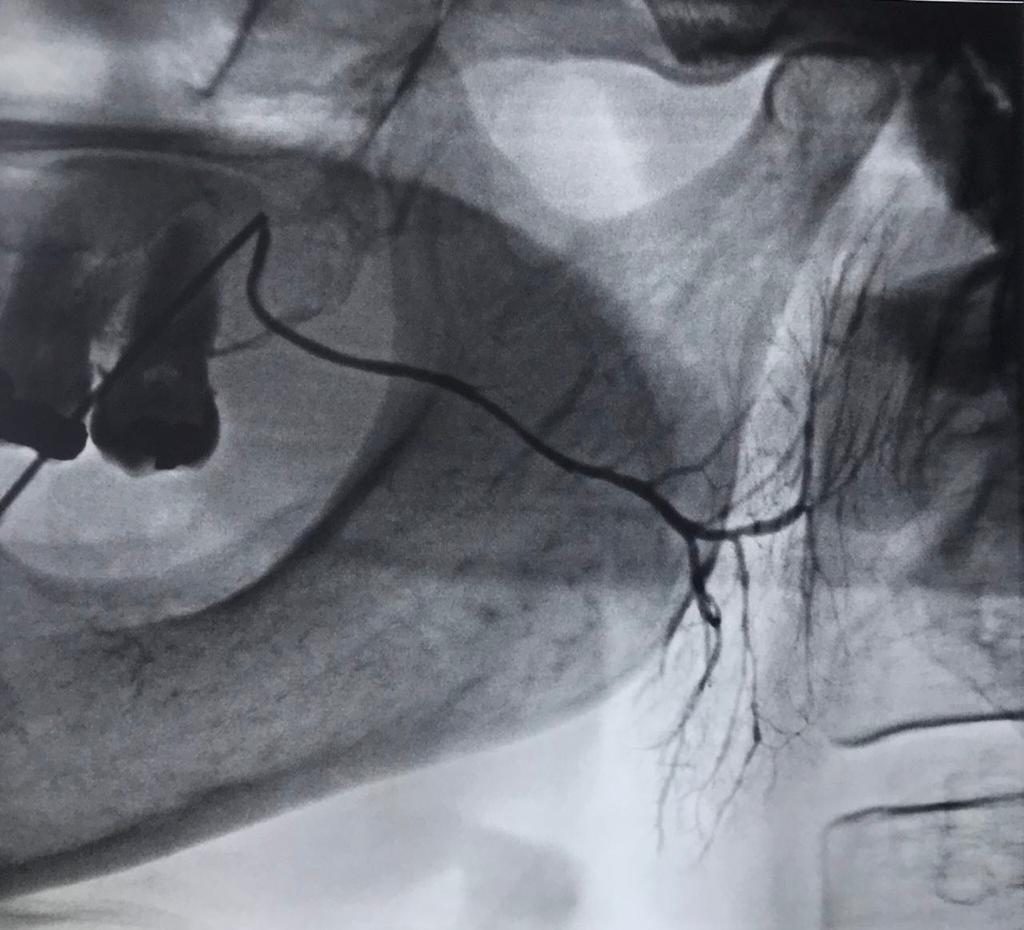 سیالوگرافی (Sialography) - مرکز تخصصی رادیولوژی دهان،فک و صورت دکتر ...