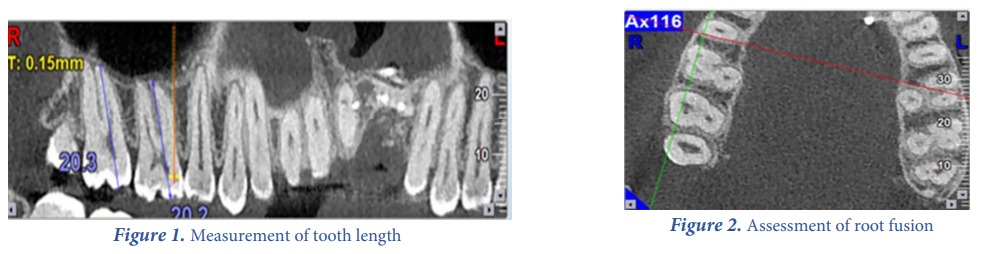 Root Canal Morphology of Maxillary Second Molars according to Age and ...